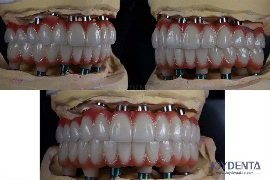 10mm Titanium Multiple Teeth Implant Rough Surface For Dental Restoration