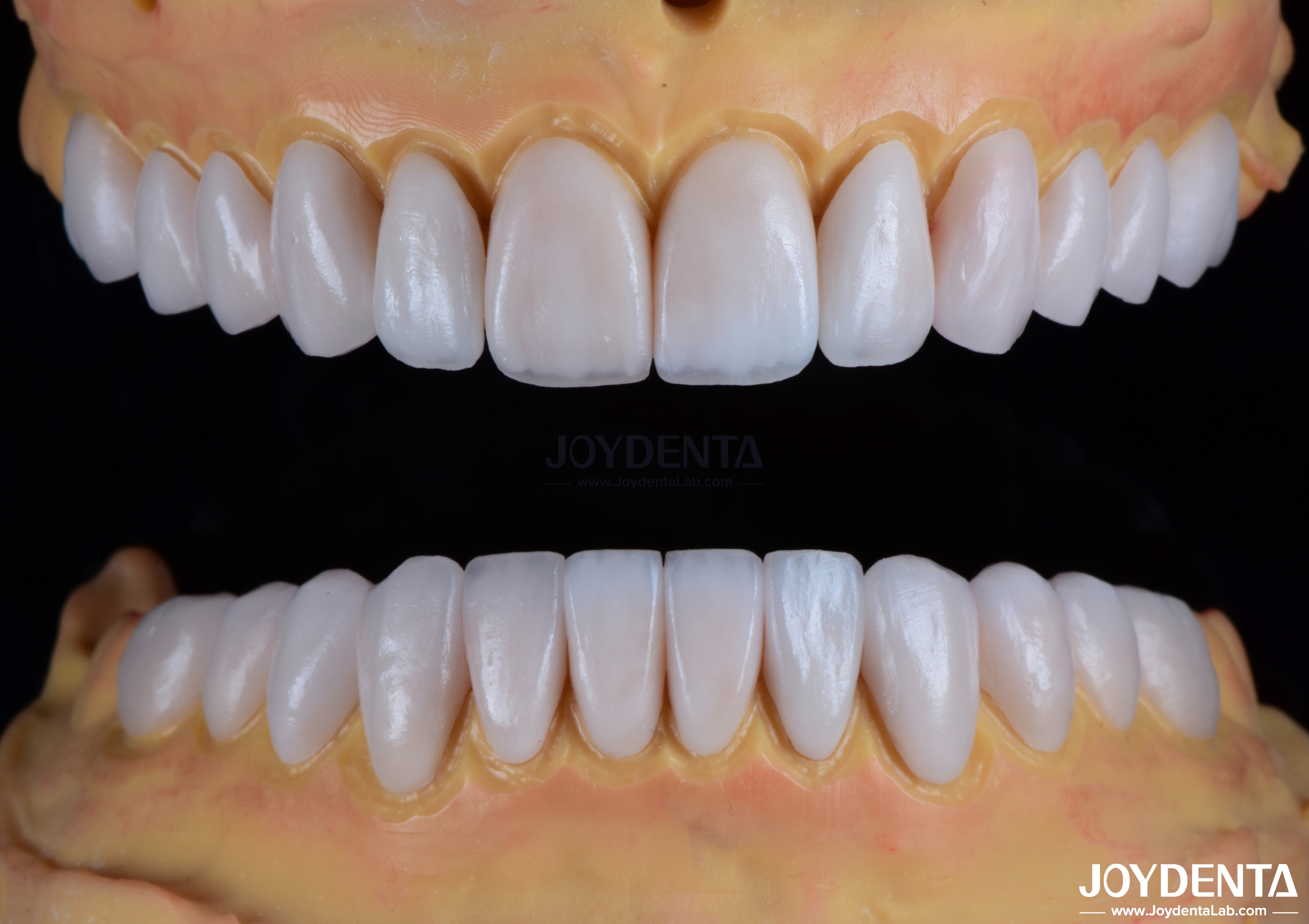 Custom Crafted Emax Porcelain Veneers Smooth Texture Dental Restorations